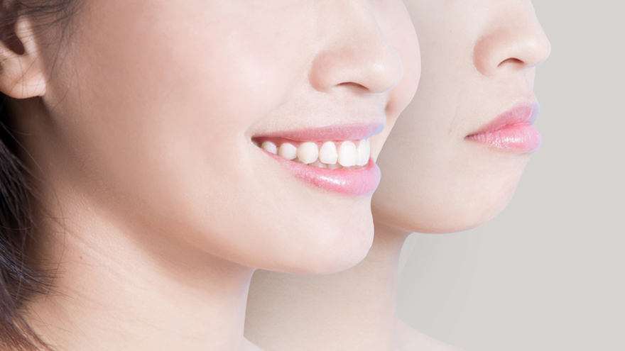 Square Jaw Surgery