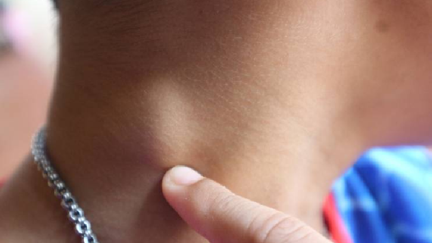 Articles | What to Do if You Have a Lump in Your Neck: Causes and Treatment