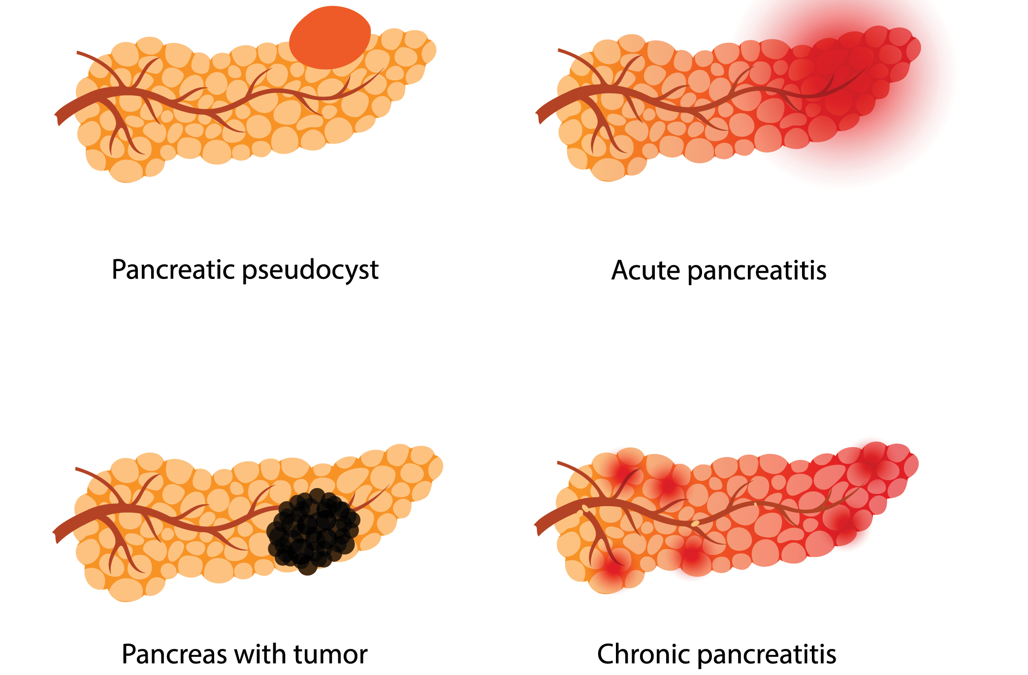Abnormality In Pancreas