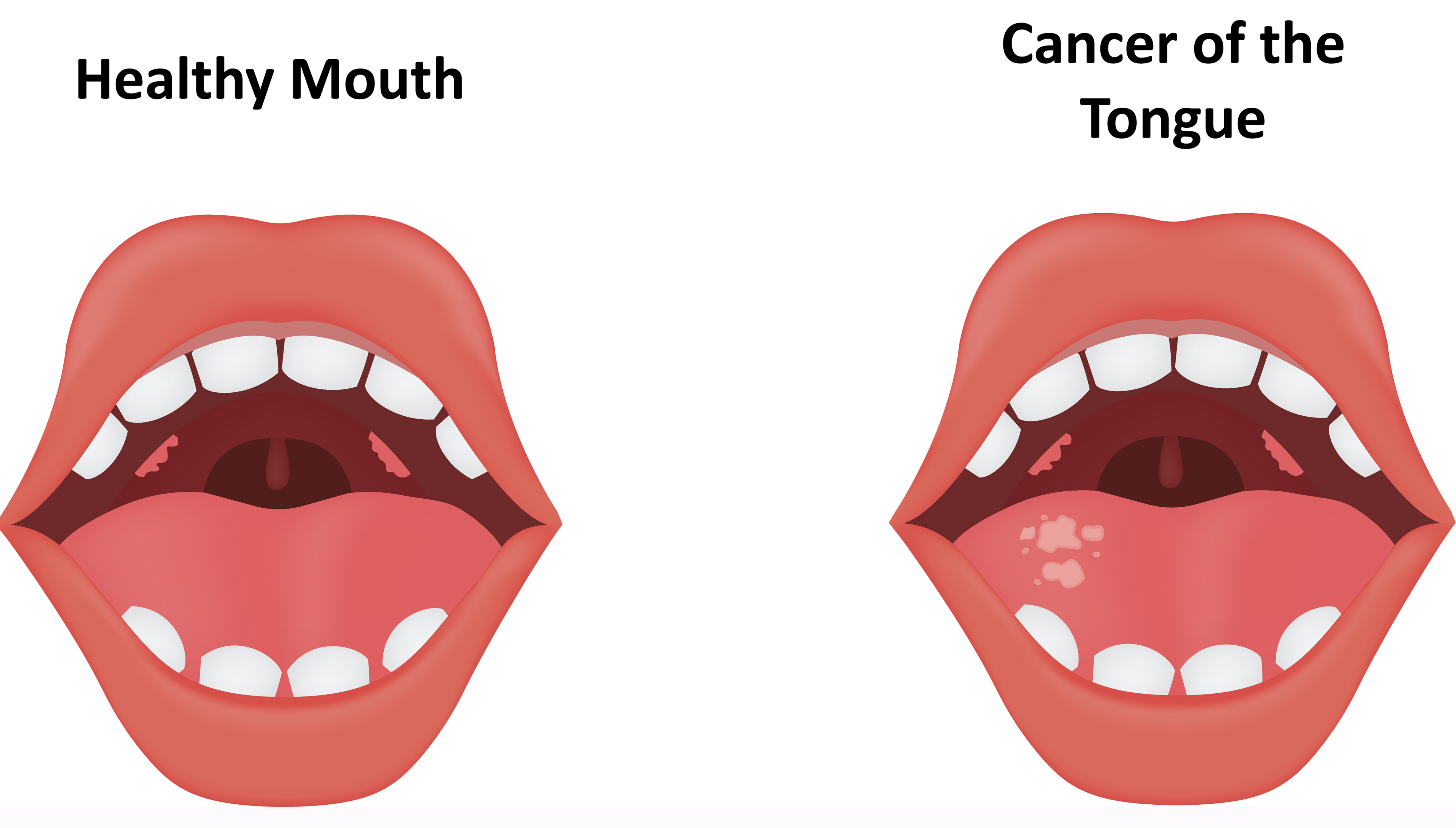 Cancer En La Lengua Imagenes