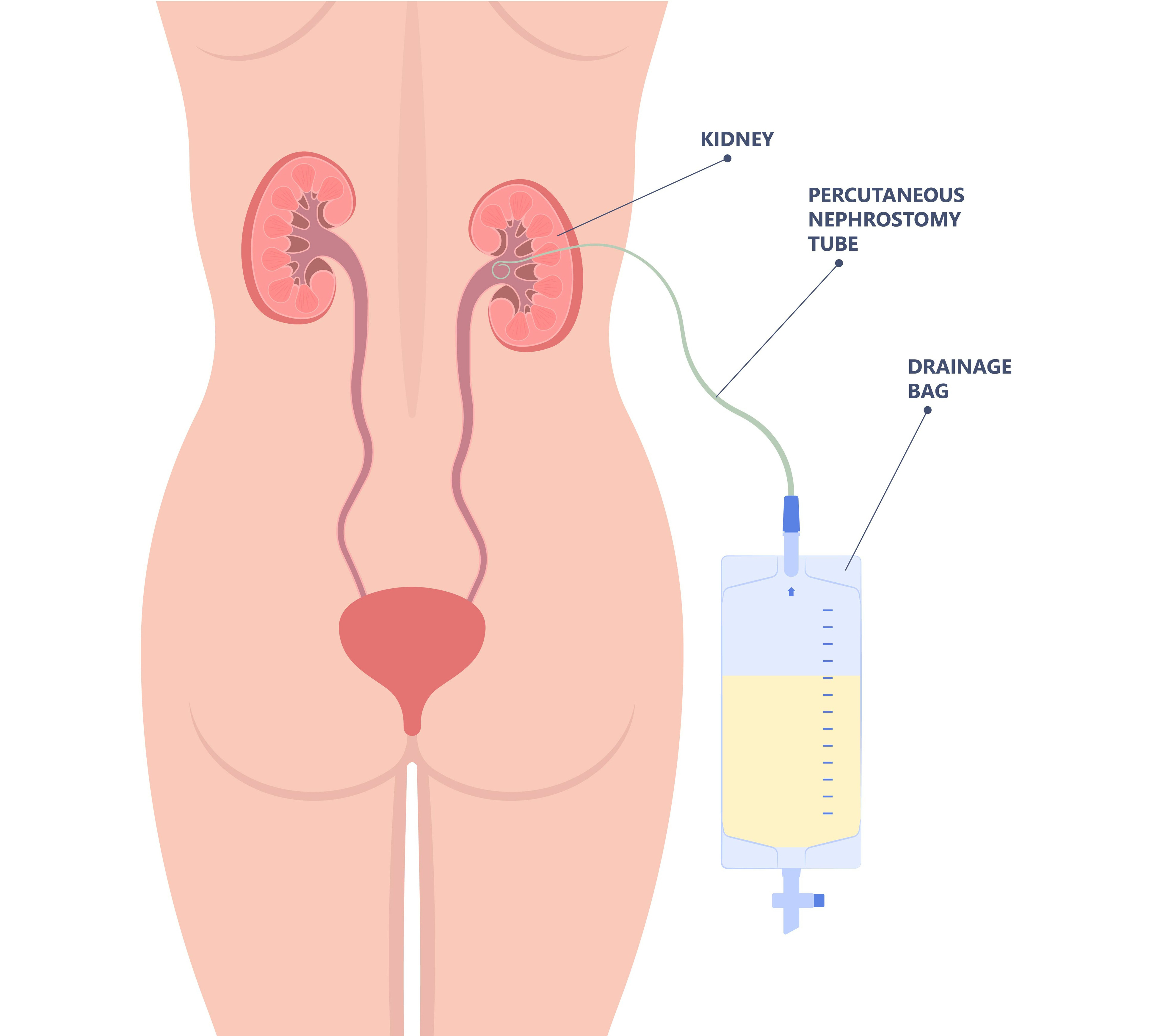 Nephrostomy Location