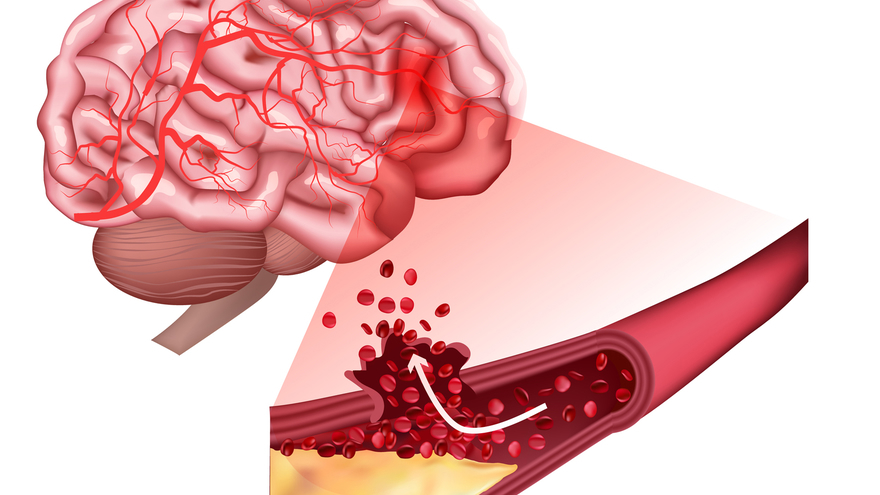 Fisiopatologia Da Hemorragia Intracerebral The Features Of ROSA