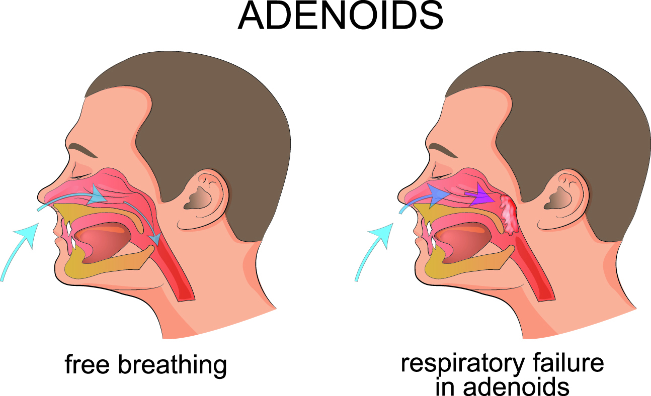 Diagrama De Amigdalas Saudaveis