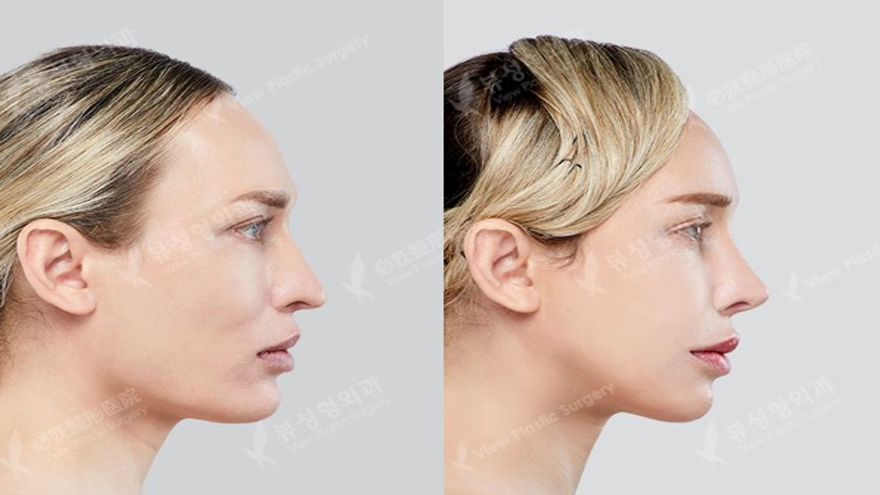 Aquiline Nose Profile