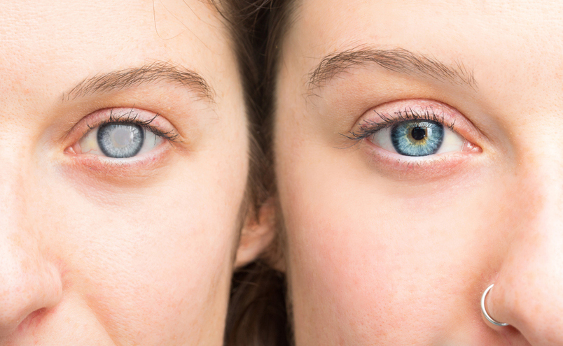 Zepto Cataract Surgery: Precision and Faster Recovery Explained