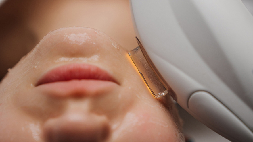 Articles | How Laser Skin Resurfacing Helps Treat Acne Scars and Uneven ...