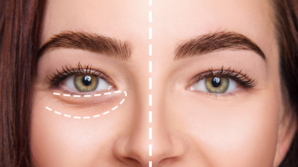 Articles | Is a Mid-Facelift Right for Sagging Under-Eye Hollows?
