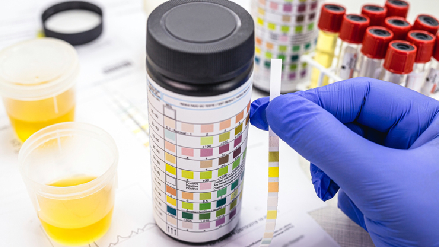 Articles | Urine Tests: What They Can Reveal About Your Kidneys and ...
