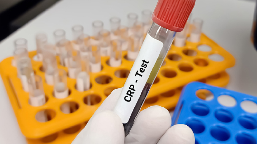C-reactive protein (CRP) is a protein produced by your liver in ...