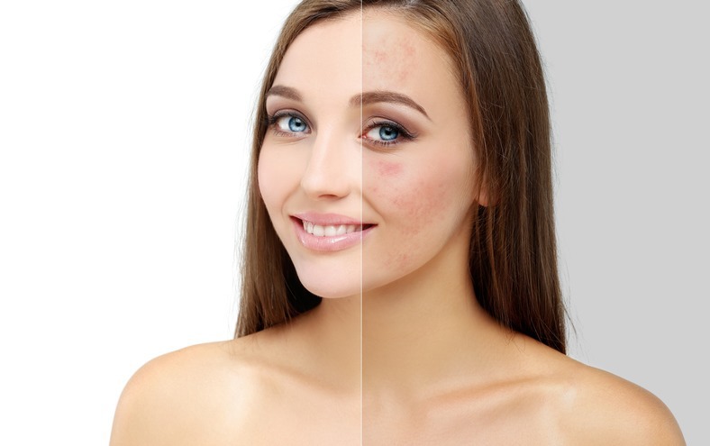 Lavieen Laser for Skin Brightening: A Complete Guide
