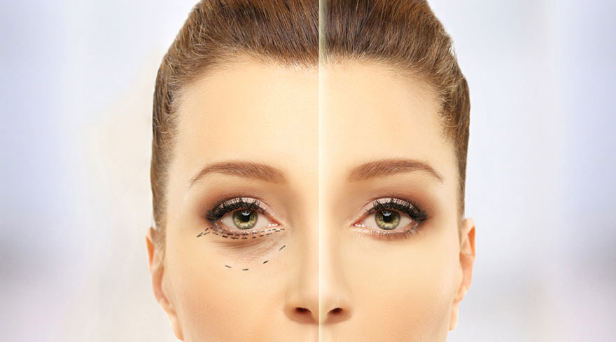 Is Under-eye Fat Grafting the Key to Reversing the Aging Process Around ...
