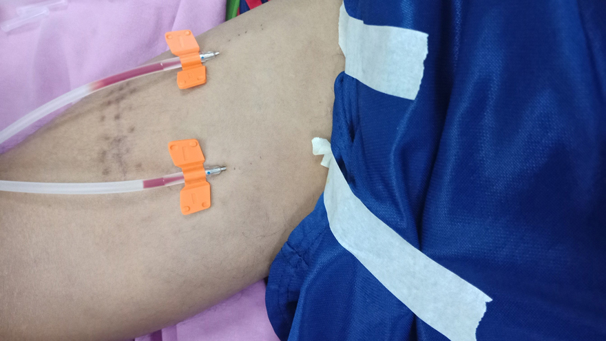 Articles | Arteriovenous Graft (AVG) Placement: What You Need to Know