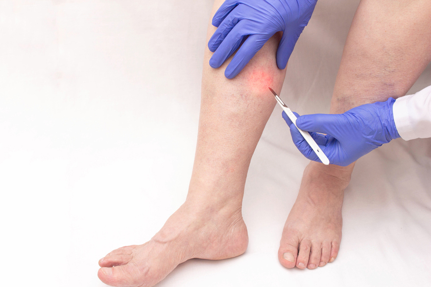 How Long Does It Take to Recover from Vein Stripping or Phlebectomy?