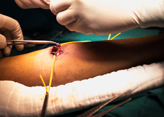 Articles | What Is the Best Aftercare for Arteriovenous Fistula Surgery?