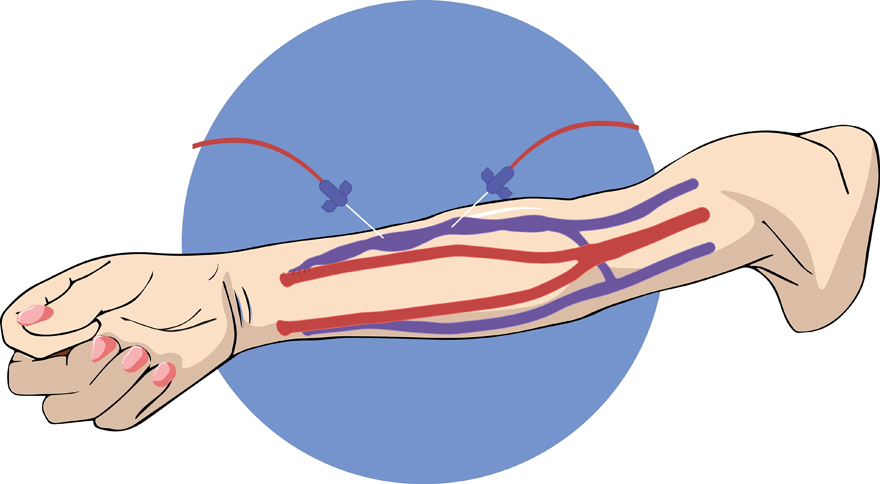 Articles | How to Take Care of Your Arteriovenous Fistula After Surgery