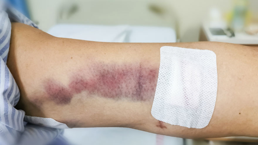 How Stem Cells Can Speed Up Recovery for Soft Tissue Injuries
