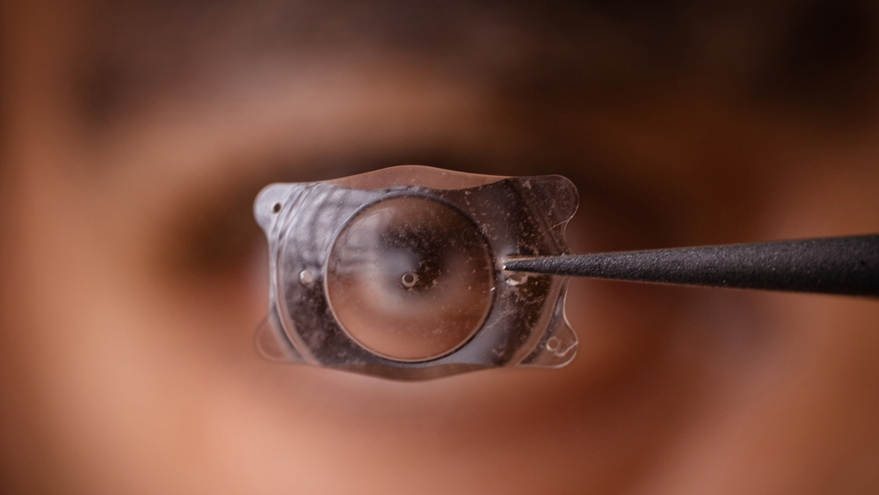 Articles | Refractive Lens Exchange (RLE): The Permanent Vision ...