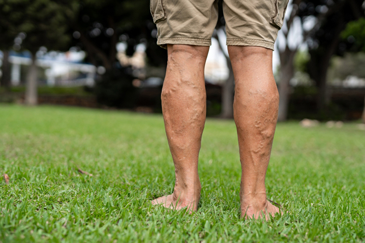 Articles | Are Varicose Veins a Serious Health Concern for Men?