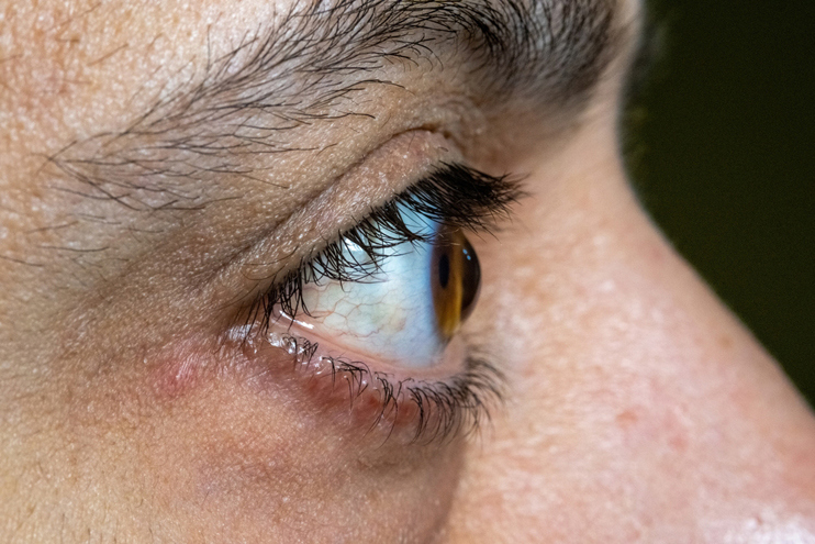 Does Avedro KXL Smile Help Treat Corneal Ectasia?