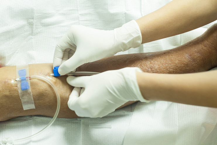 How to Prevent Stenosis in Dialysis Access Sites