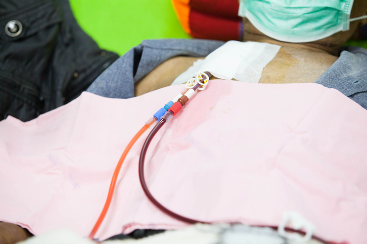 Articles | What Is Dialysis Vascular Access & Why Is It Important?