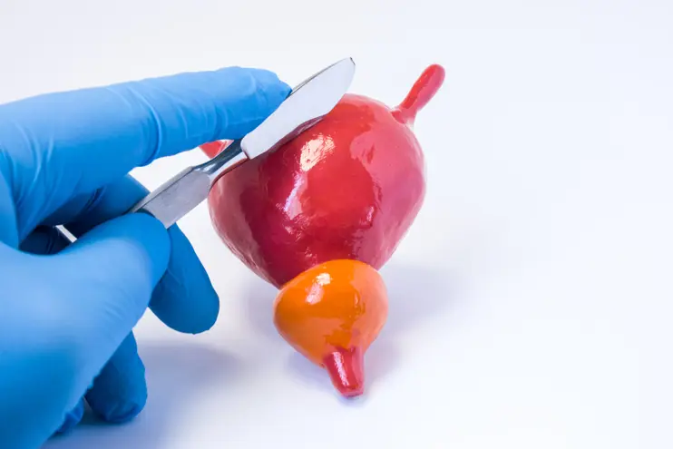 Bladder Removal Surgery (Cystectomy)