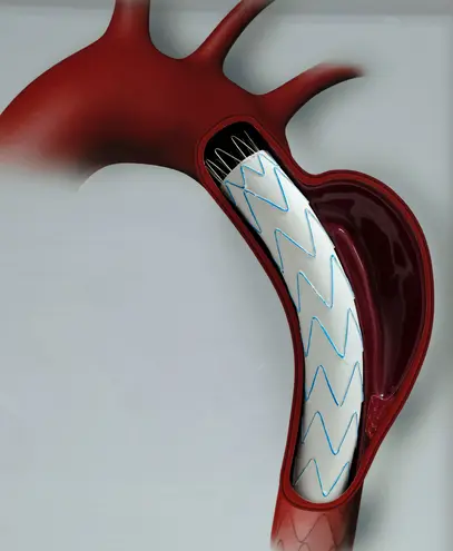 Thoracic endovascular aortic repair (TEVAR)