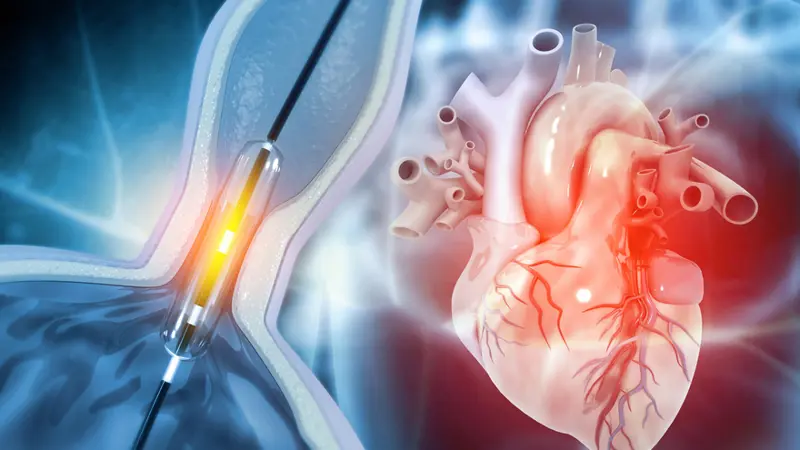 PCI (Percutaneous Coronary Intervention)