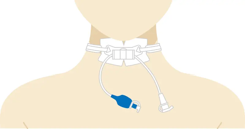 Tracheostomy Procedure