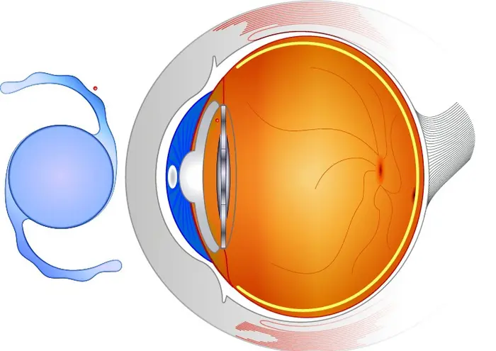 Phakic Intraocular Lens (PIOL) Implant Surgery
