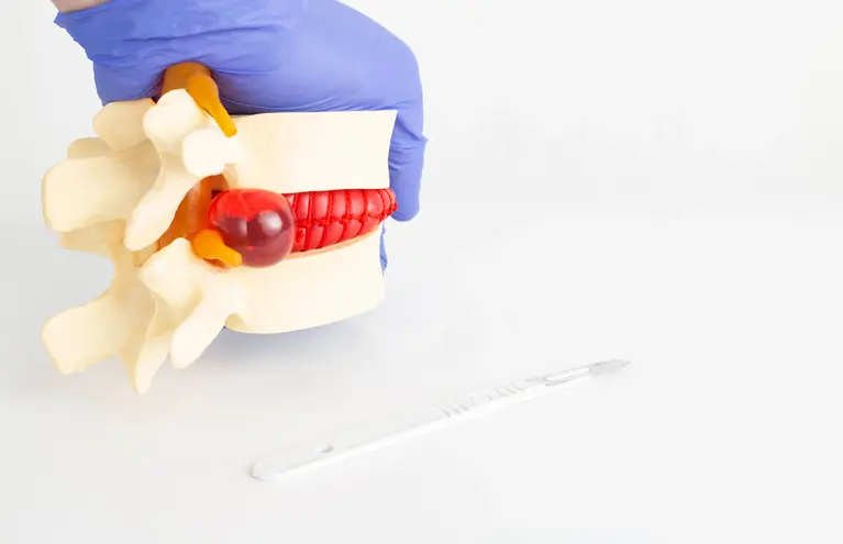 Open lumbar discectomy