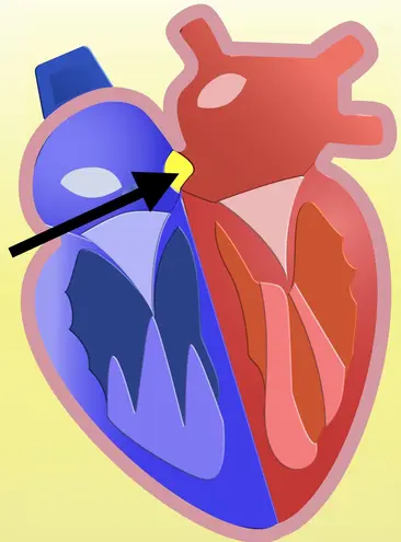 ASD (Atrial Septal Defect) Repair