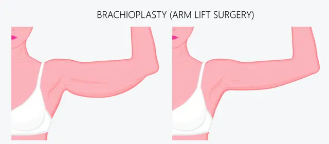 Arm Lift Surgery (Brachioplasty)