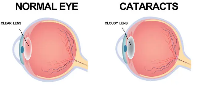 Cataract Diagnosis and Treatment