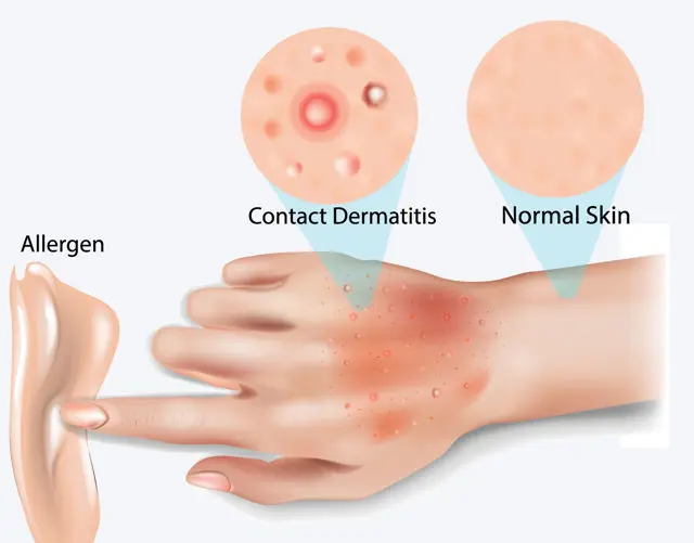 Contact Dermatitis Treatment 7499