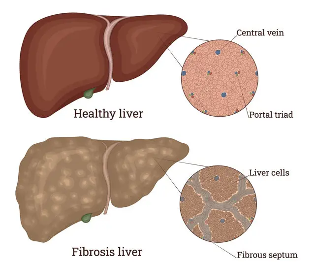 Diagnóstico y Manejo de la Fibrosis Hepática