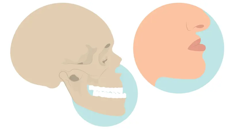 Bone Reshaping Surgery (Osteotomy)