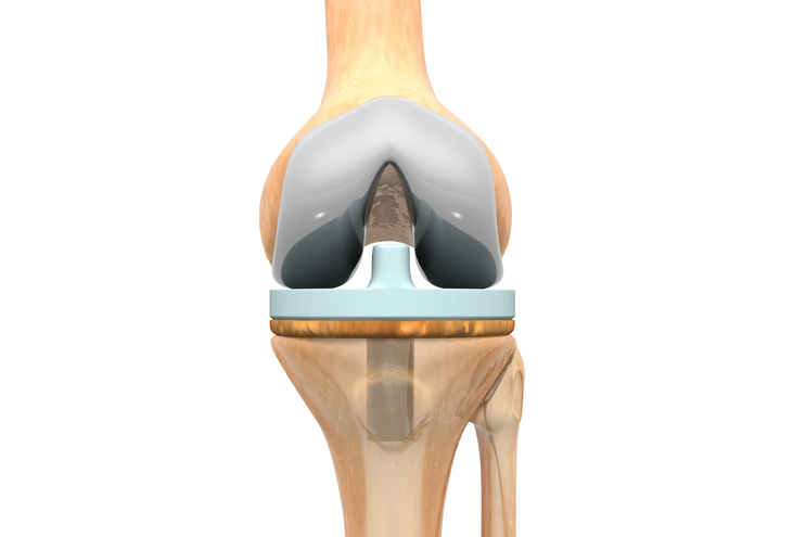 Visas kelio sąnario pakeitimo operacija