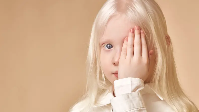 Understanding Albinism: A Complete Guide to Causes, Symptoms, and ...