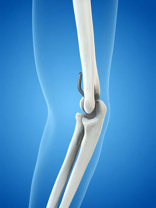 Elbow Joint Replacement Surgery