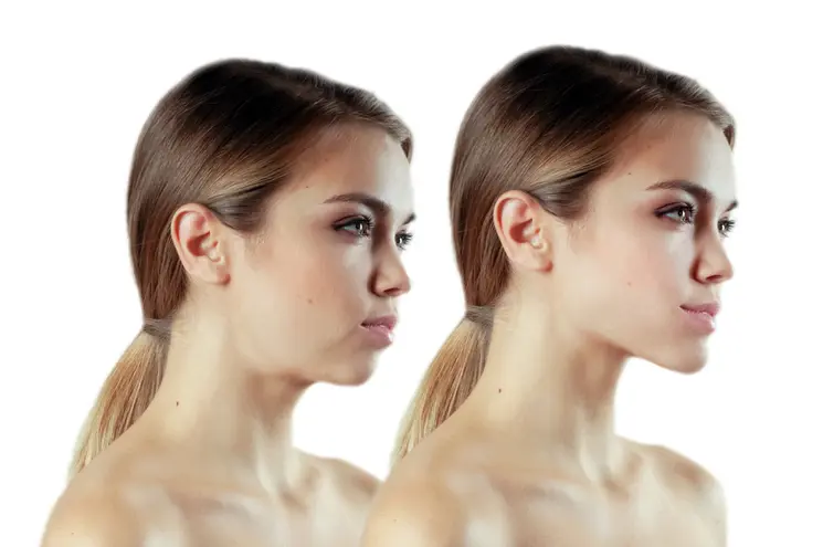 Jaw Realignment Surgery Orthognathic Surgery