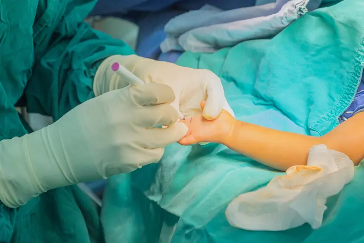 Webbed Fingers and Toes (Syndactyly)