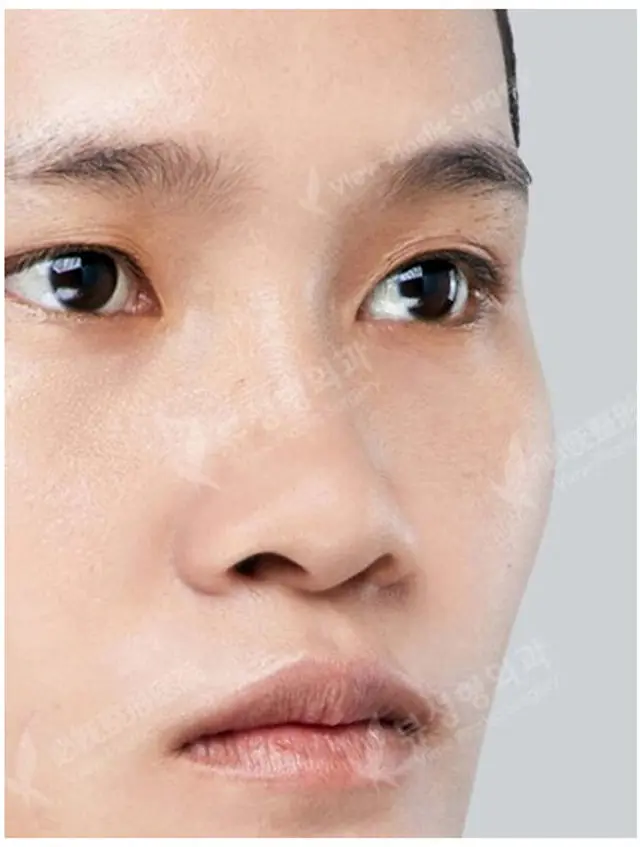 Nasal Alar Reduction Surgery