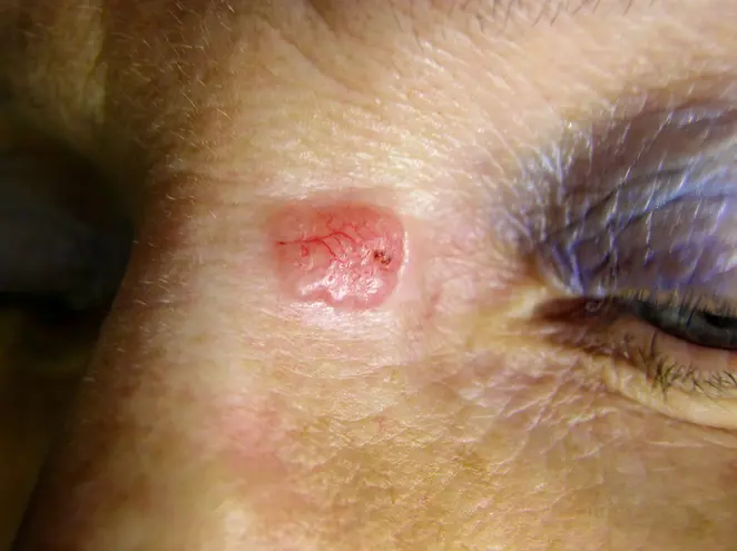 Basal Cell Carcinoma (Basalioma) Treatment