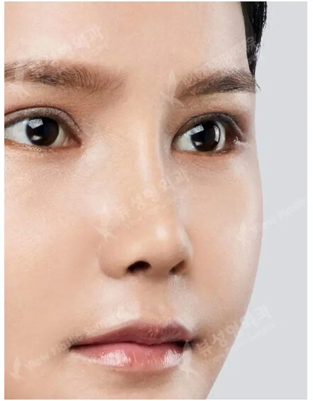 Nasal Alar Reduction Surgery