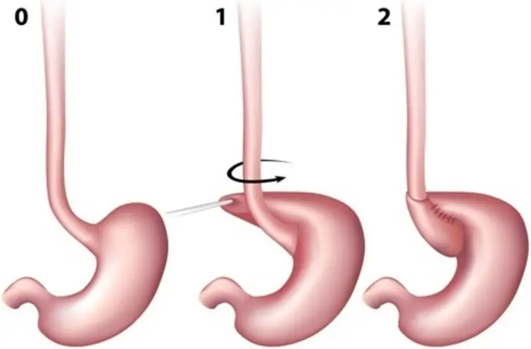 Stomach Hernia (Gastrocele) Treatment