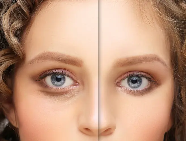 Middle-age Under Eye Fat Re-positioning Middle-age Under Eye Fat Re-positioning