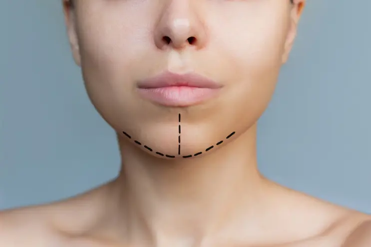 V-Line Chin Contouring Surgery
