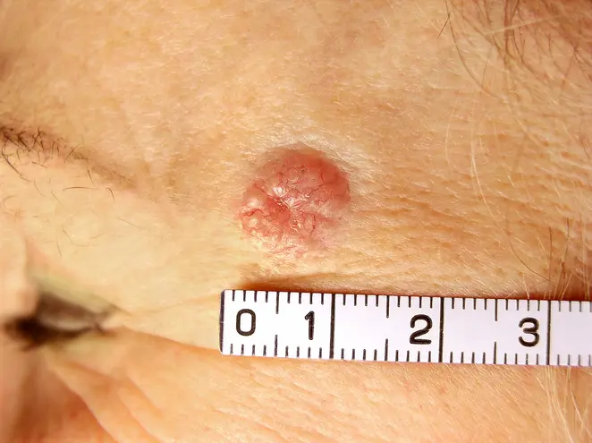 Basal Cell Carcinoma (Basalioma) Treatment
