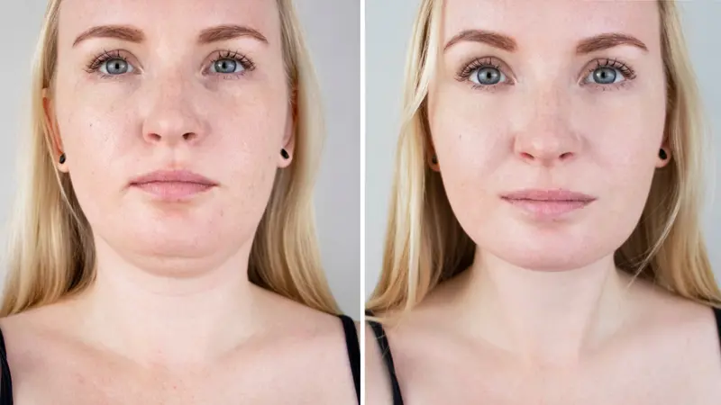 A Patient's Guide to Affordable Face Contouring in South Korea